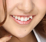 yaeba | メープル矯正歯科 院長ブログ